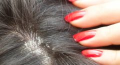 Black Women & CCC Alopecia: 5 Things You Must Know | Page 2 of 4 ...