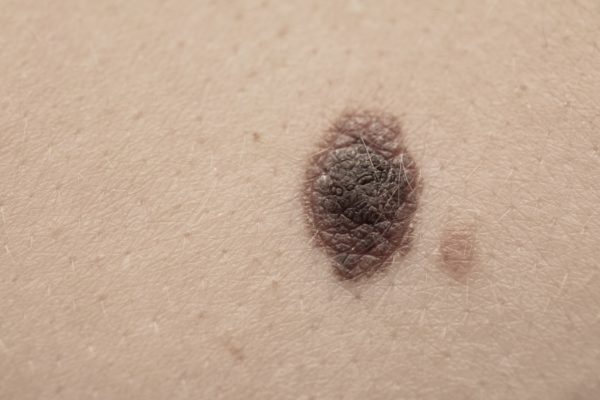 6 Signs Your Mole May be Cancerous. Here's How to Tell... - BlackDoctor ...