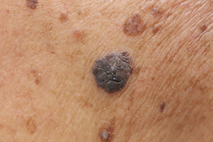 Black Salve A Fake Home Remedy For Skin Cancer, FDA Confirms ...