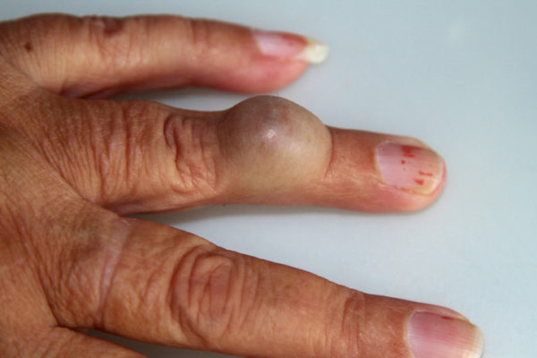 Black Bump on Skin: Types, Causes & When to Worry