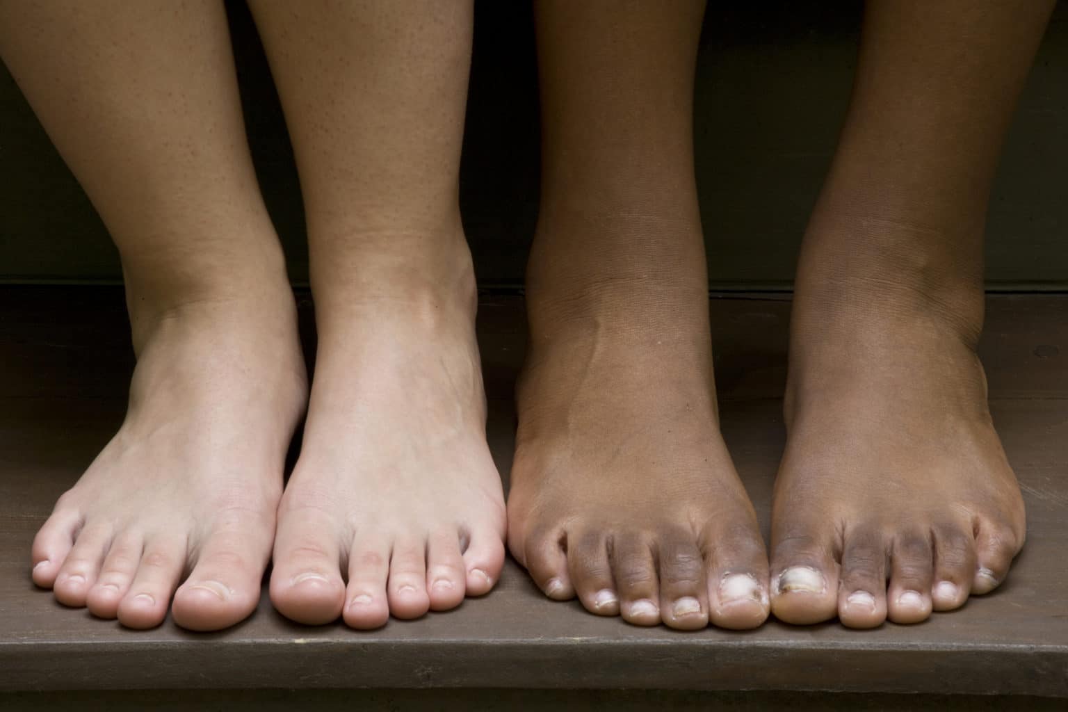 'COVID Toes' Might Be a Sign You Had the Disease - BlackDoctor.org