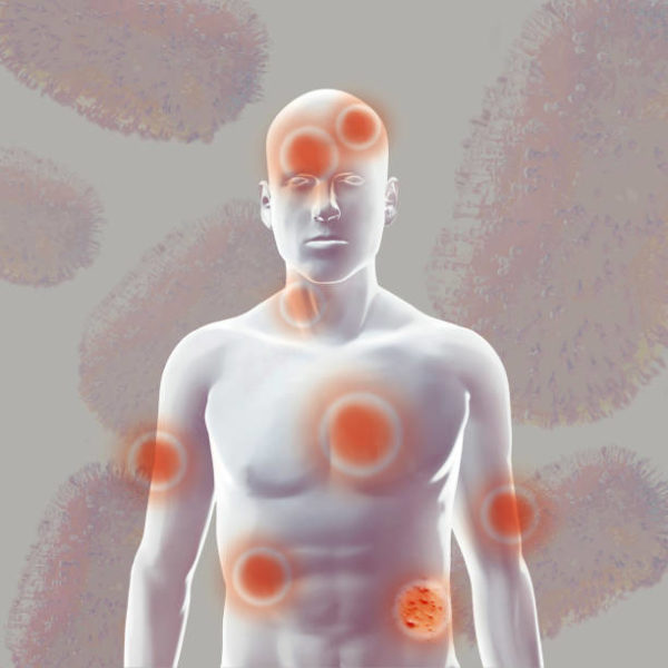 A Dermatologist Offers Tips On Recognizing the Monkeypox Rash