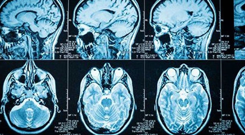 Different Types of Brain Tumors: What They Are, How They Present and ...